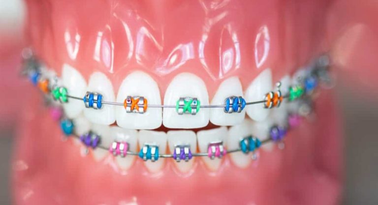 How to Choose Braces Colors that Brighten Your Teeth?