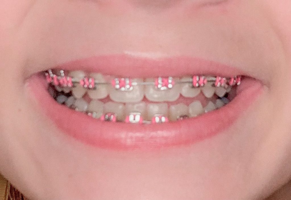 best braces colors to get | light pink braces